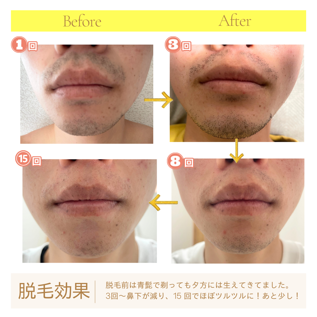 セルフ脱毛サロン｜SELFDUCK（セルフダック）｜都度払い｜個室